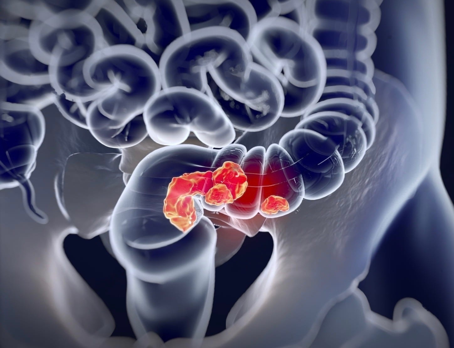 Colon-sicuro, Azione: “Un po’ di sangue per diagnosi tempestiva di ...